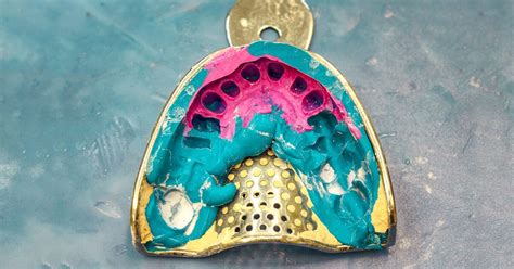 Dental Implant Vs Bridge Pros Cons And Which To Choose