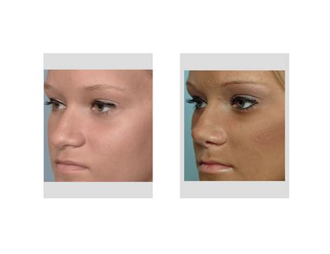 Female Cheek Implants Dr Barry Eppley Indianapolis Explore Plastic