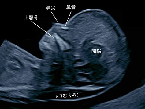 What Is NT CRIFM Prenatal Medical Clinic