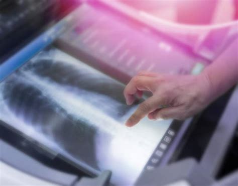 Chest X Ray Icu