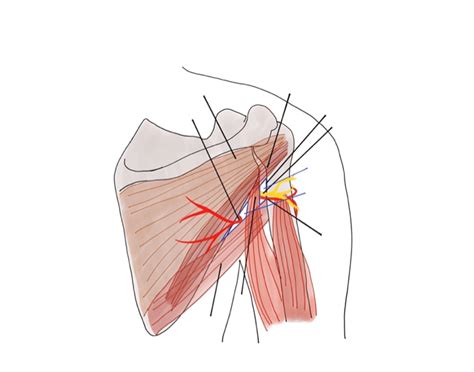 Quadrangular And Triangular Anatomical Spaces Quiz