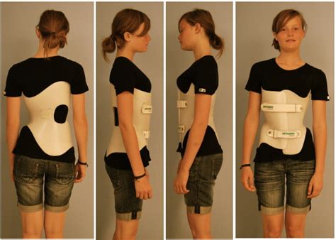 A Short Brace To Address The Thoracolumbar Curve Pattern 4ctl The