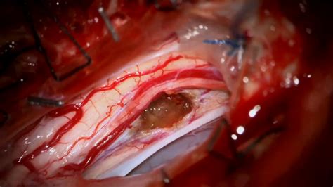 234 Microsurgical Resection Of An Intramedullary Thoracic Spinal Cord