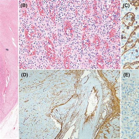 Microscopic Examination Confirmed The Splenic Tissue Histology Which