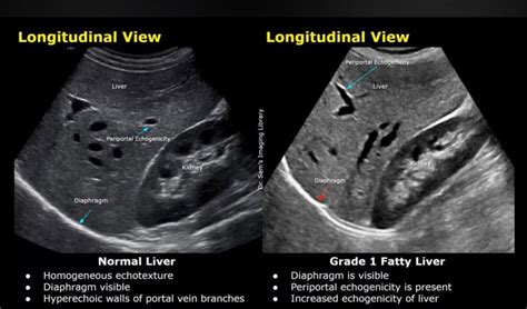 Dr Mohsen Alotaibi On Linkedin Fatty Liver Infiltration Steatosis Grading Is Very Crucial In
