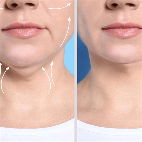 What Are The Steps To A Facelift Procedure Webb Plastic Surgery