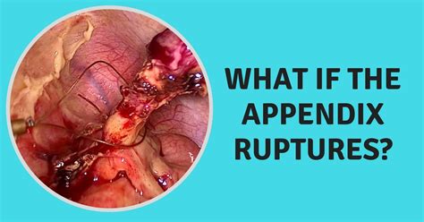 What Happens If Appendix Bursts Appendix Surgery In Chennai Dr Maran