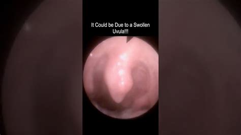 Swollen Uvula