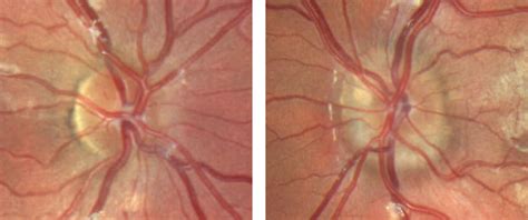 Optic Disc Hyperemia At Zoe Walker Blog