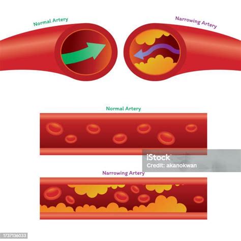 Normal Artery And Narrow Artery Because Cholesterol Fat Cell Stock