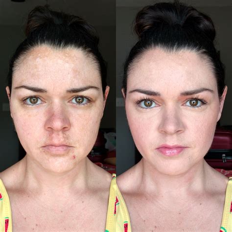 Best Full Coverage Makeup For Melasma