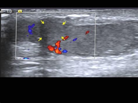 Testicular Torsion Blue Dot Sign At Walter Lawrence Blog