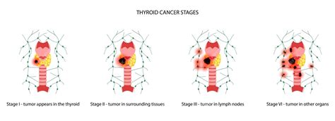Premium Vector Thyroid Cancer Stages