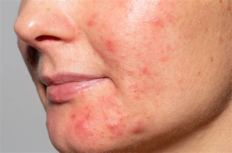 Jerawat Batu Gejala Penyebab Dan Pengobatan Halodoc