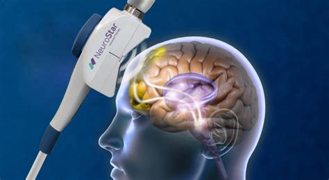 About Tms Neurosciences Clinics