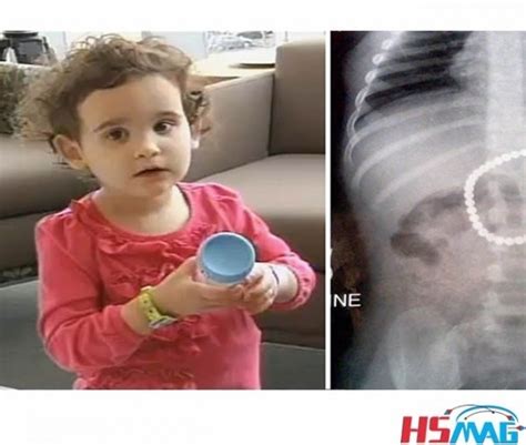 A Girl Swallowed Toy Magnet By Mistake And The Doctor Took It Out