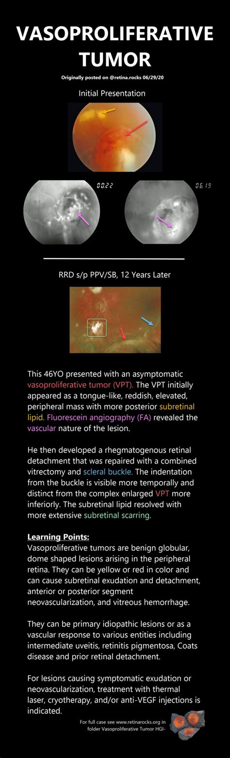 Neoplastic Retina Disorders Vasoproliferative Tumor Retina Rocks