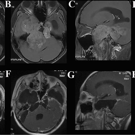 Case Illustrating The Endoscopic Endonasal Approach A C
