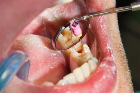 Tooth That Needs Root Canal