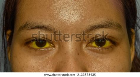 711 Jaundice Woman Images Stock Photos Vectors Shutterstock