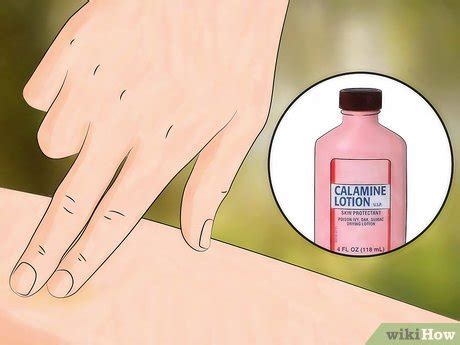 Ways To Get Rid Of Bug Bites WikiHow