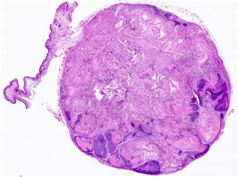 Histologia Do Pilomatricoma