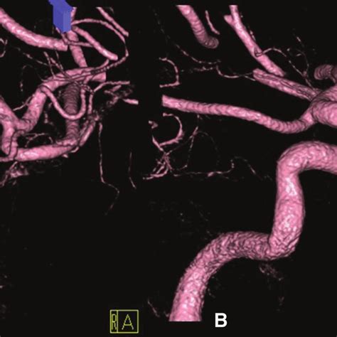 A Preoperative Left Internal Carotid Angiography Angle At Which The Download Scientific
