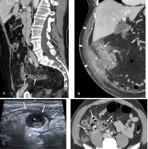 Update On Acute Appendicitis Typical And Untypical Findings Radiología English Edition