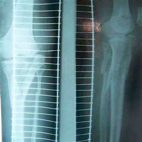Showing The Tongue Type Calcaneal Fracture In The Same Patient Download Scientific Diagram