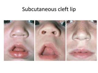 Unilateral Cleft Lip Pptx