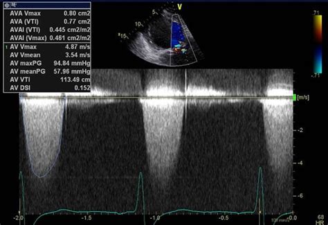 Tte With Cw Spectral Doppler Profile Of Aortic Valve Demonstrating Download Scientific Diagram