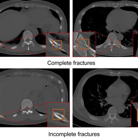 Fractures Identified By The Algorithm The Algorithm Helped Identify Download Scientific