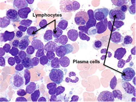 Secretory B Cell Neoplasm Flashcards Quizlet