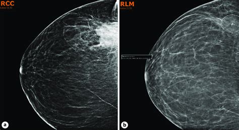 Radiographic Response To Neoadjuvant Chemotherapy A Mammogram Image At Download Scientific