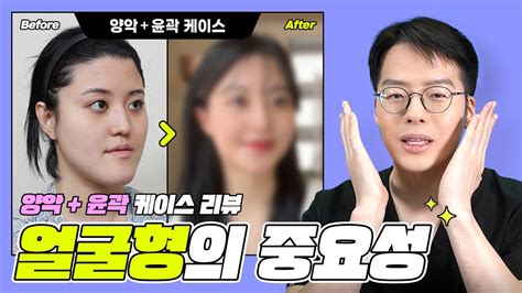 얼굴형이 눈 코보다 중요합니다 기린성형외과 구강악안면외과 Youtube