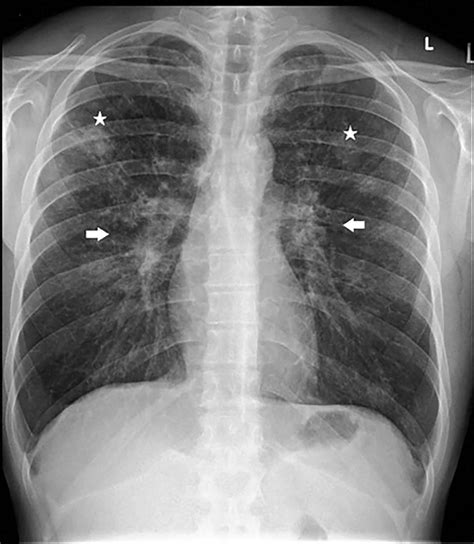 Ciliary Body Granuloma Masquerading As A Melanoma Eye News