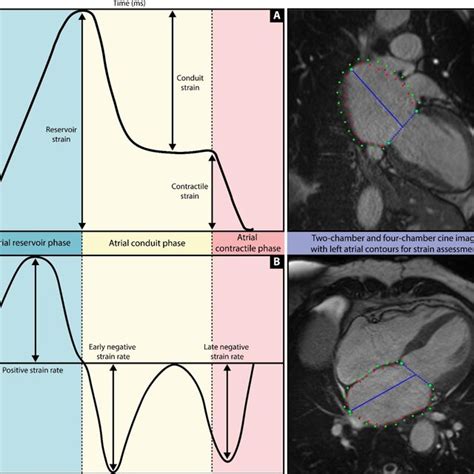 la strain in an af patient with a non spherical and spherical la