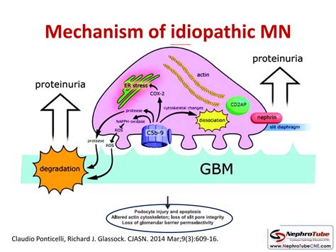 Membranous Nephropathy Management Algorithm Dr Gawad Ppt