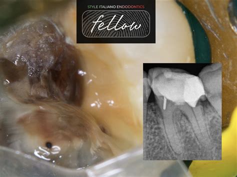 Cases Page 2 Of 38 Style Italiano Endodontics