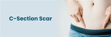 C Section Scar