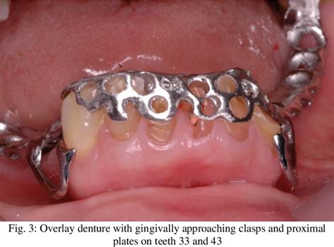 Figure 3 From Restoring Occlusal Vertical Dimension Of Kennedy Class I