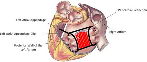Robotic Enhanc The American Association For Thoracic Surgery Aats