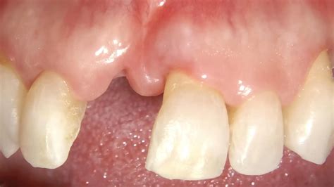 Soft Tissue Augmentation In Zone 21