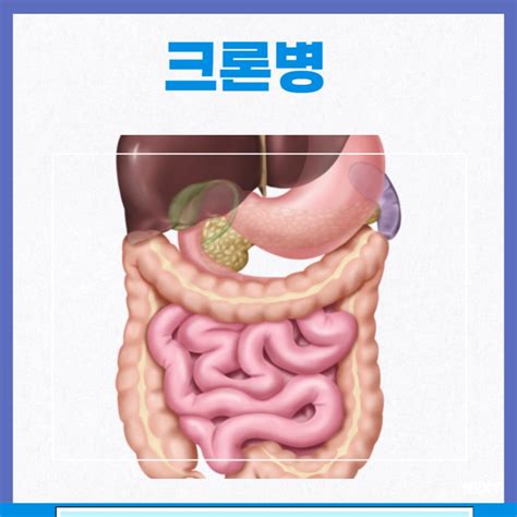 크론병 증상 원인 진단 치료 네이버 블로그