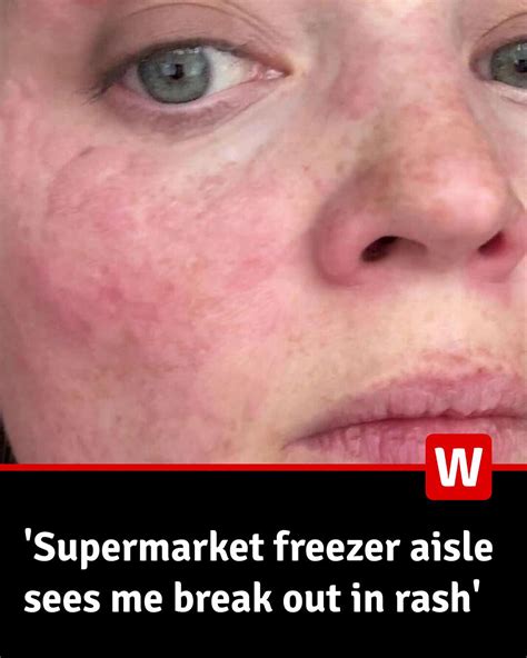 Walesonline Kirsten Evans Suffers Such A Severe Reaction To Cold