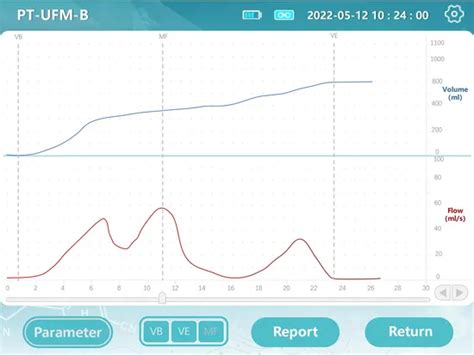 Equipment Used In Urology Pc Serie1100ml Normal Uroflowmetry Graph Male
