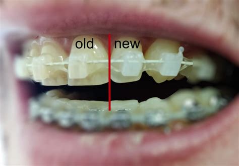 Clear Braces Stained