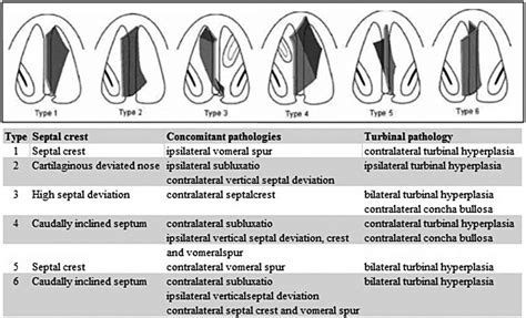 Six Types Of Nasal Septal Deviation Baumann Et Al 2007 10 Download Scientific Diagram