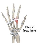 Metacarpal Neck