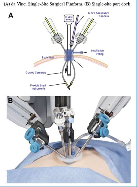 Robotic Assisted Laparoscopic Total Hysterectomy At Neida Tracy Blog